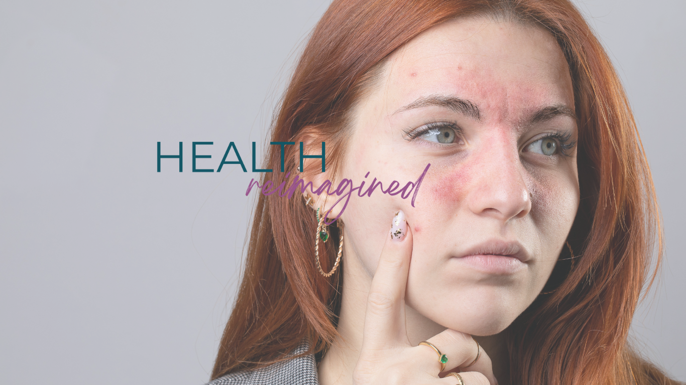 Introduction: Rosacea as an Expression of Systemic Interactions - MedSelect